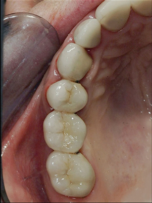 Implant placement vs. tooth retention | Dental Economics