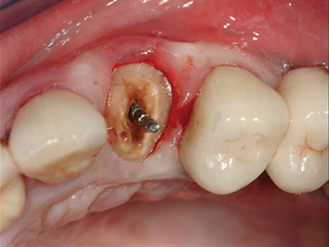 Implant placement vs. tooth retention | Dental Economics