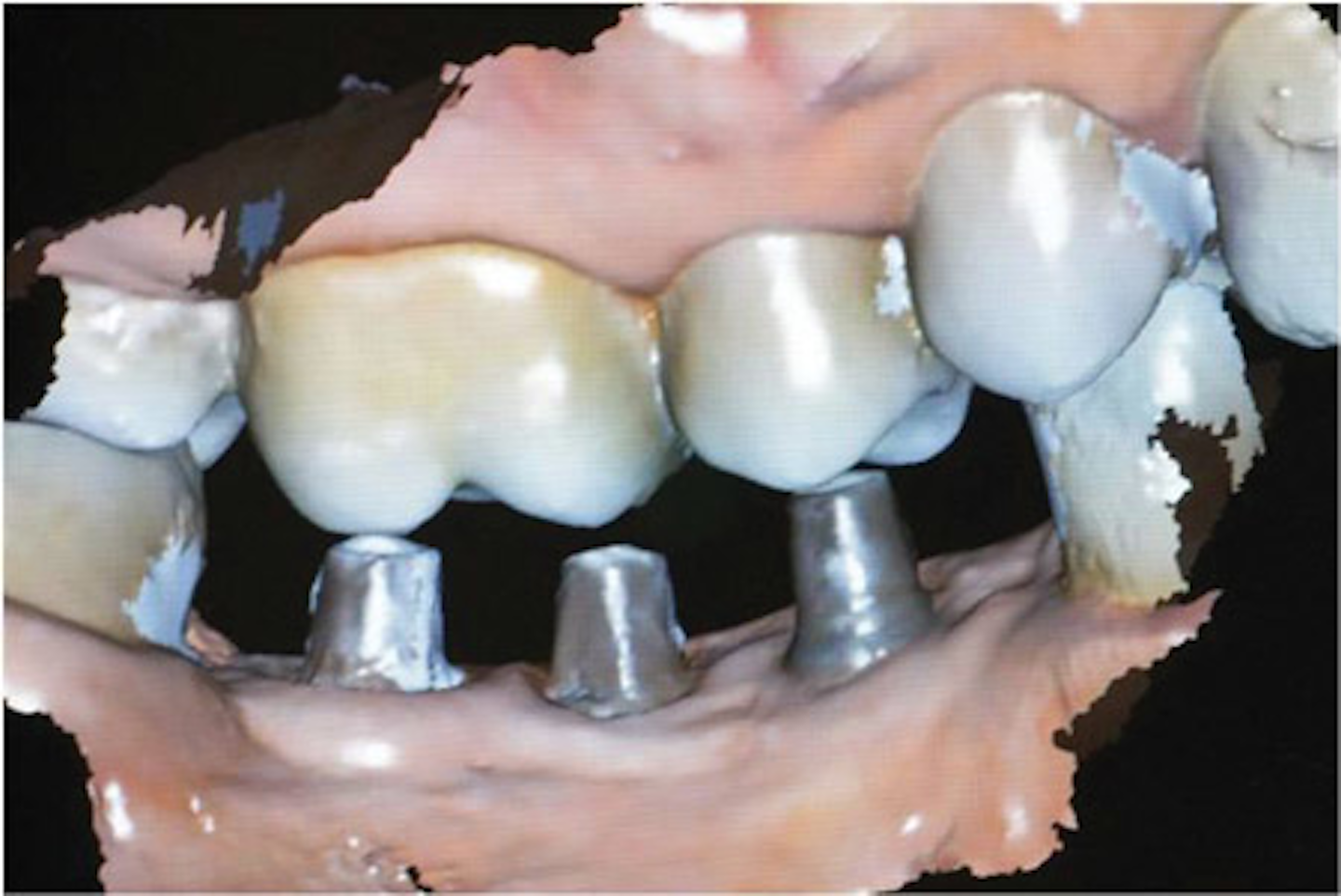 Using digital impressions for implants | Dental Economics
