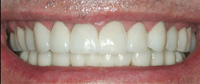 Zirconia and lithium disilicate restorations versus PFM | Dental Economics