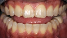 Tooth color modification: A discussion on the history, mechanism, and ...