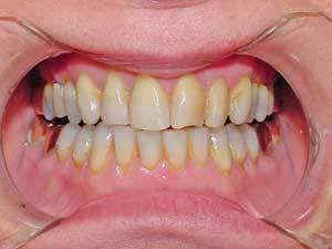 Increasing patient acceptance of smile makeovers with minimally ...