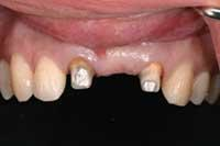 Laser-assisted pontic preparation | Dental Economics