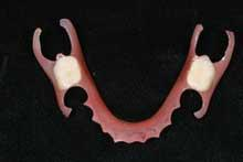Unilateral Removable Partial Denture