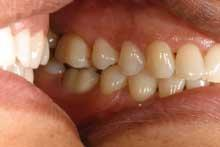 Valplast: Flexible, aesthetic partial dentures | Dental Economics