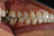 Valplast: Flexible, aesthetic partial dentures | Dental Economics