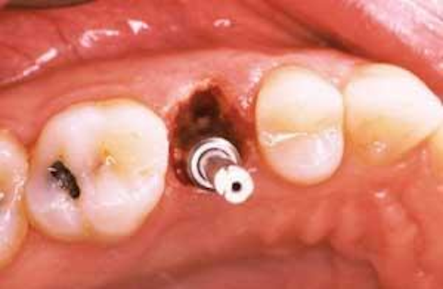 Immediate implant placement and the Socket Seal classification | Dental Economics