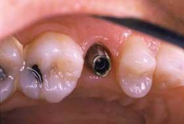 Immediate implant placement and the Socket Seal classification | Dental ...