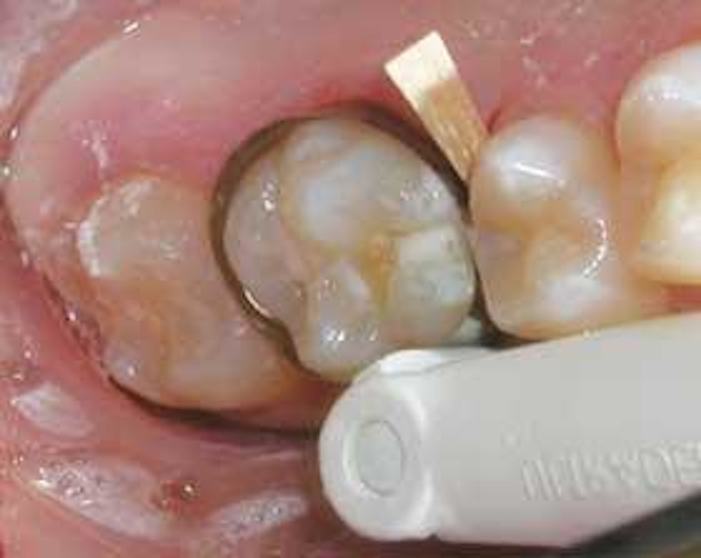Matrix bands for primary and permanent Class II composite restorations ...