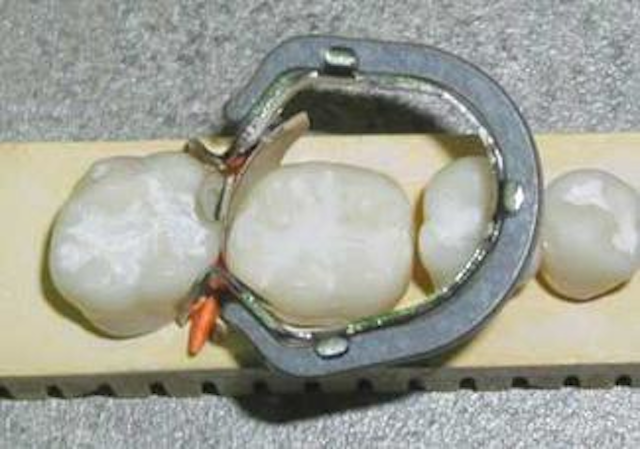 Matrix bands for primary and permanent Class II composite restorations ...