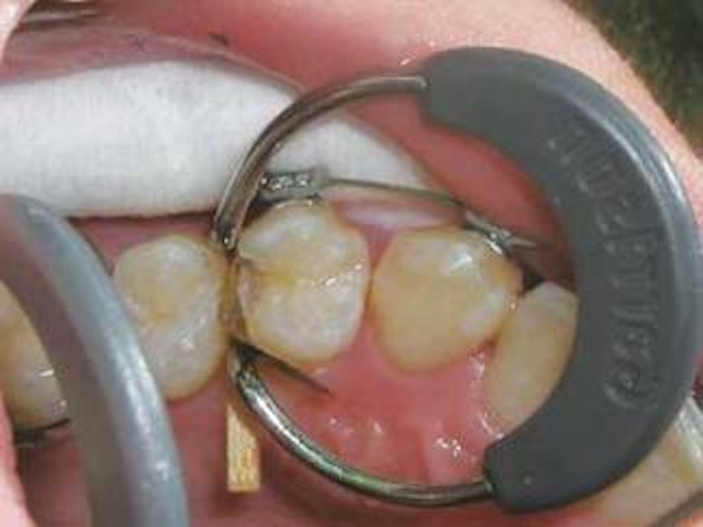 Matrix bands for primary and permanent Class II composite restorations ...
