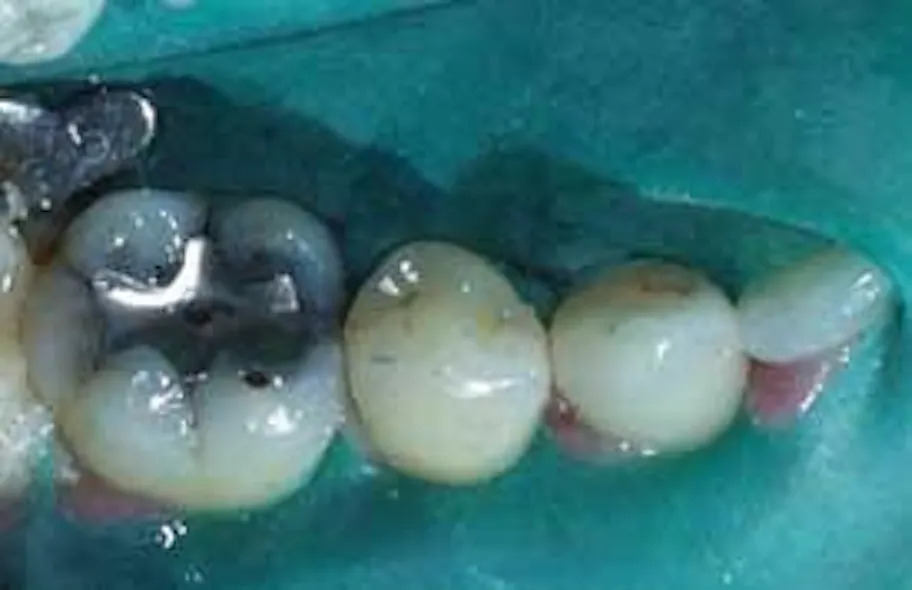 Nanohybrid composite restorations: Dentistry's most versatile solution ...