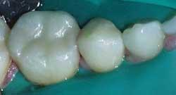 Nanohybrid composite restorations: Dentistry's most versatile solution ...