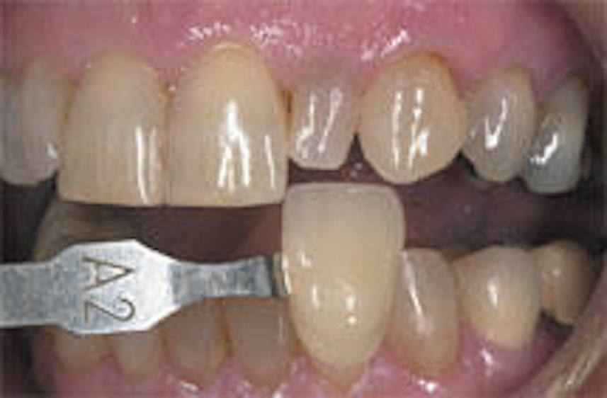 Shade Matching for Today's Dentistry | Dental Economics