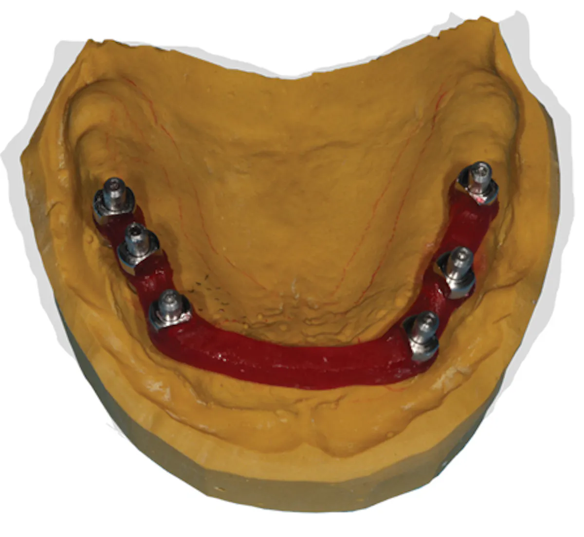Make a good first impression: A guide to accurate full-arch implant ...