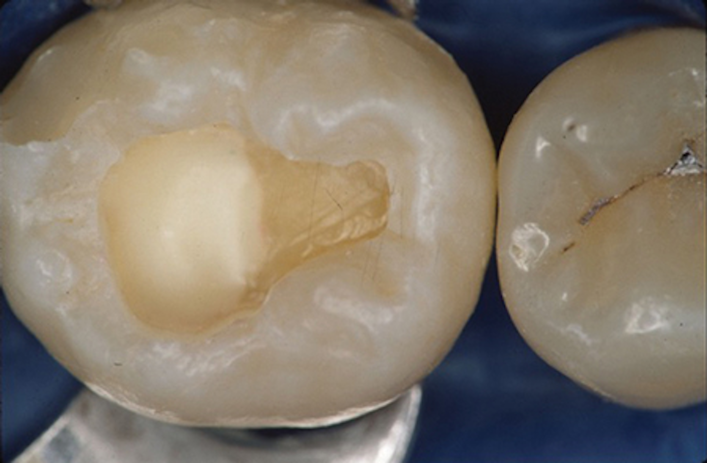 Pulp cap or endo? | Dental Economics