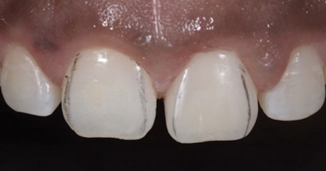 Give life to your restorations: Effective anterior composite contouring ...