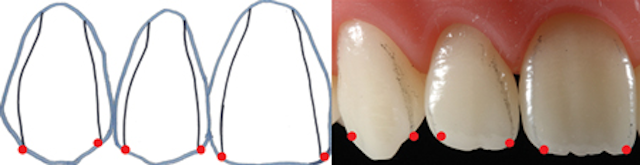 Give life to your restorations: Effective anterior composite contouring ...