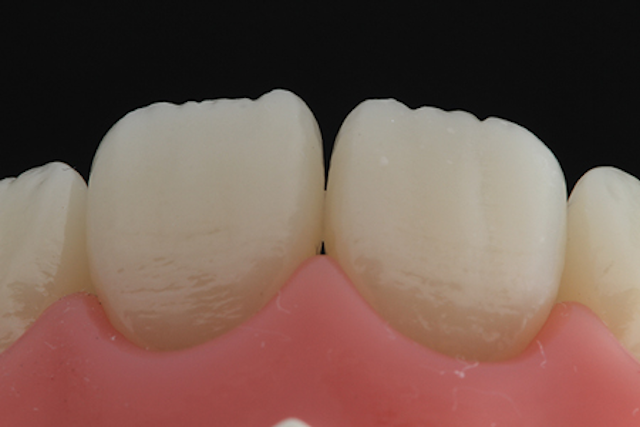 Give life to your restorations: Effective anterior composite contouring ...