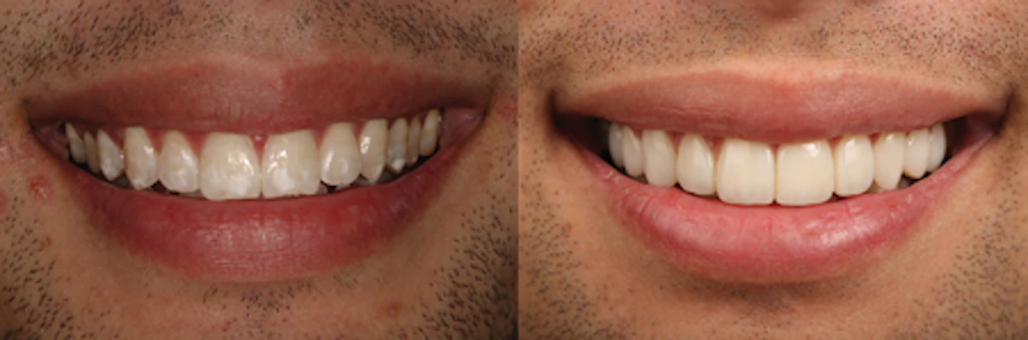 Give life to your restorations: Effective anterior composite contouring ...