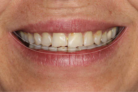 Smile design to development: A predictable way to create anterior ...