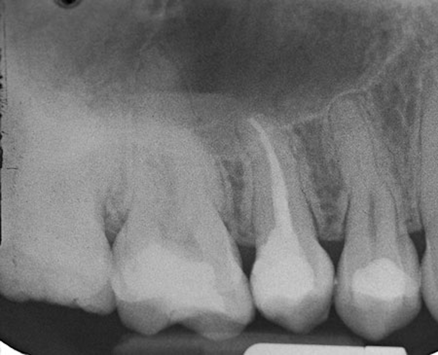 The benefits of bulk fill, adaptation, and radiopacity | Dental Economics