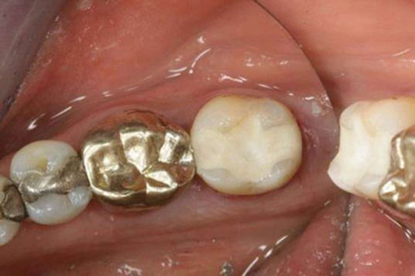 Revisiting glass ionomer as a restorative material | Dental Economics