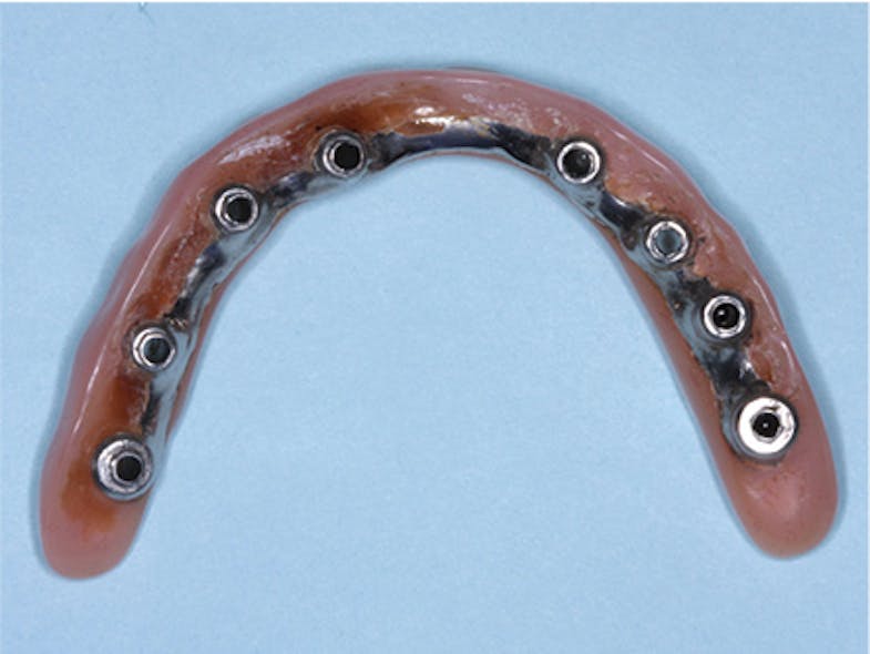 Are fixed or removable prostheses best for edentulous patients ...