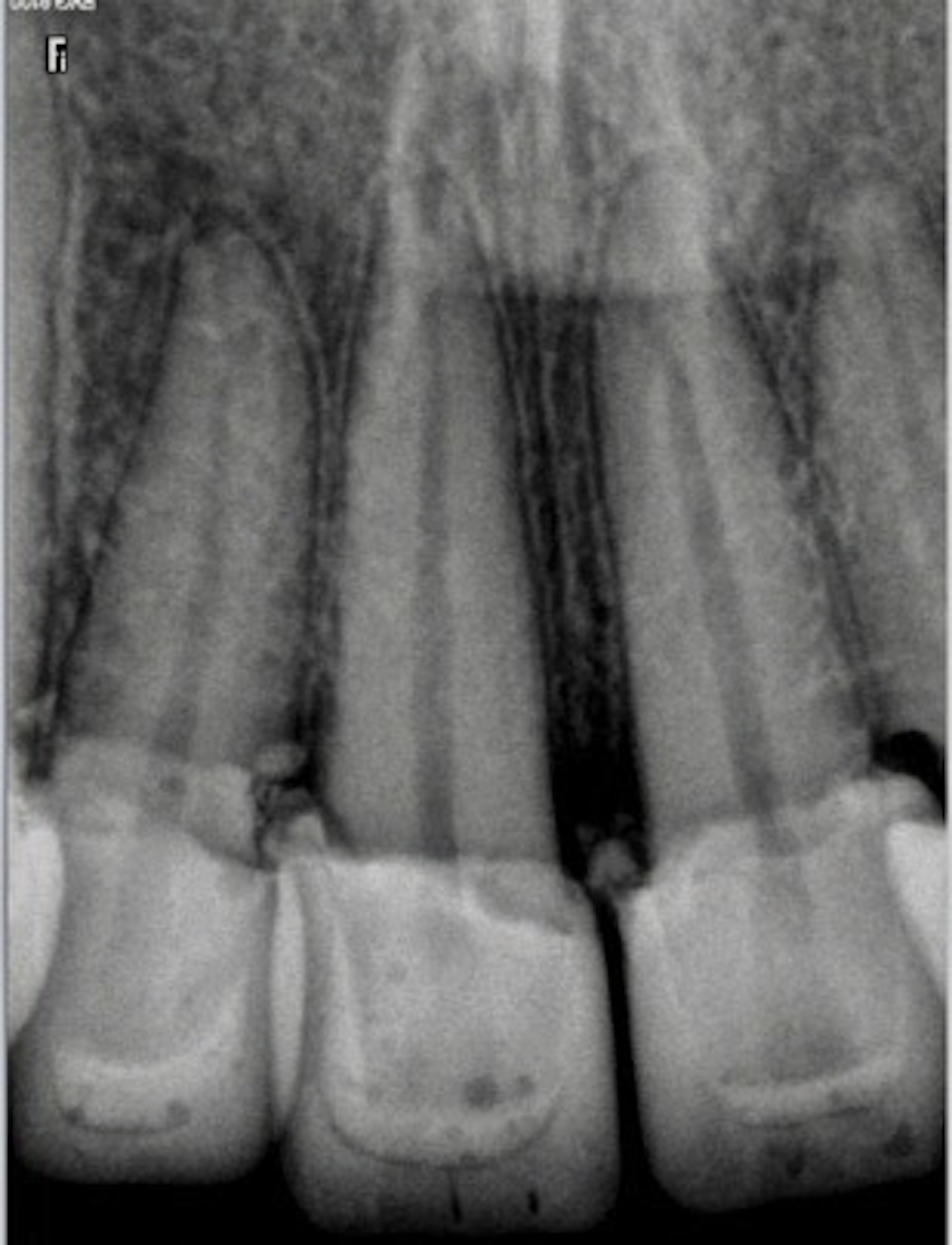 Impressions and provisionals: A simplified method for crown and bridge ...