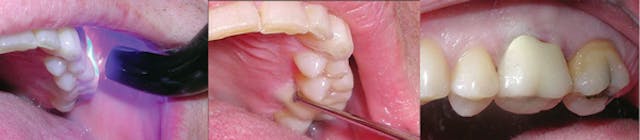 Dual-cure resin cements improve luting | Dental Economics