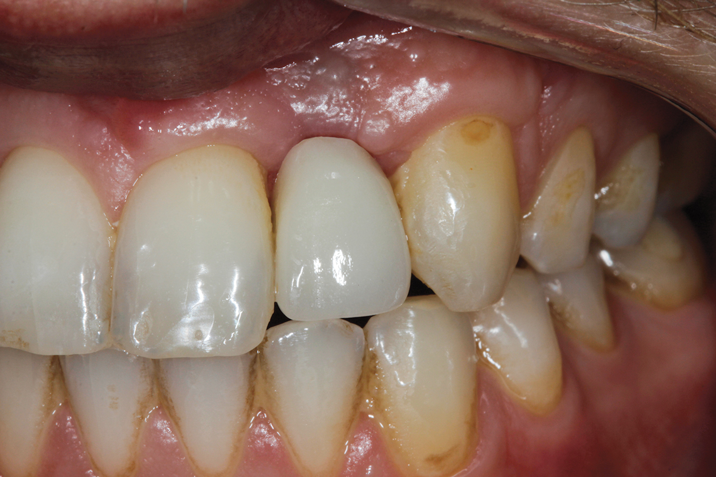 Bone grafting after tooth removal: Why, when, and what to use | Dental ...