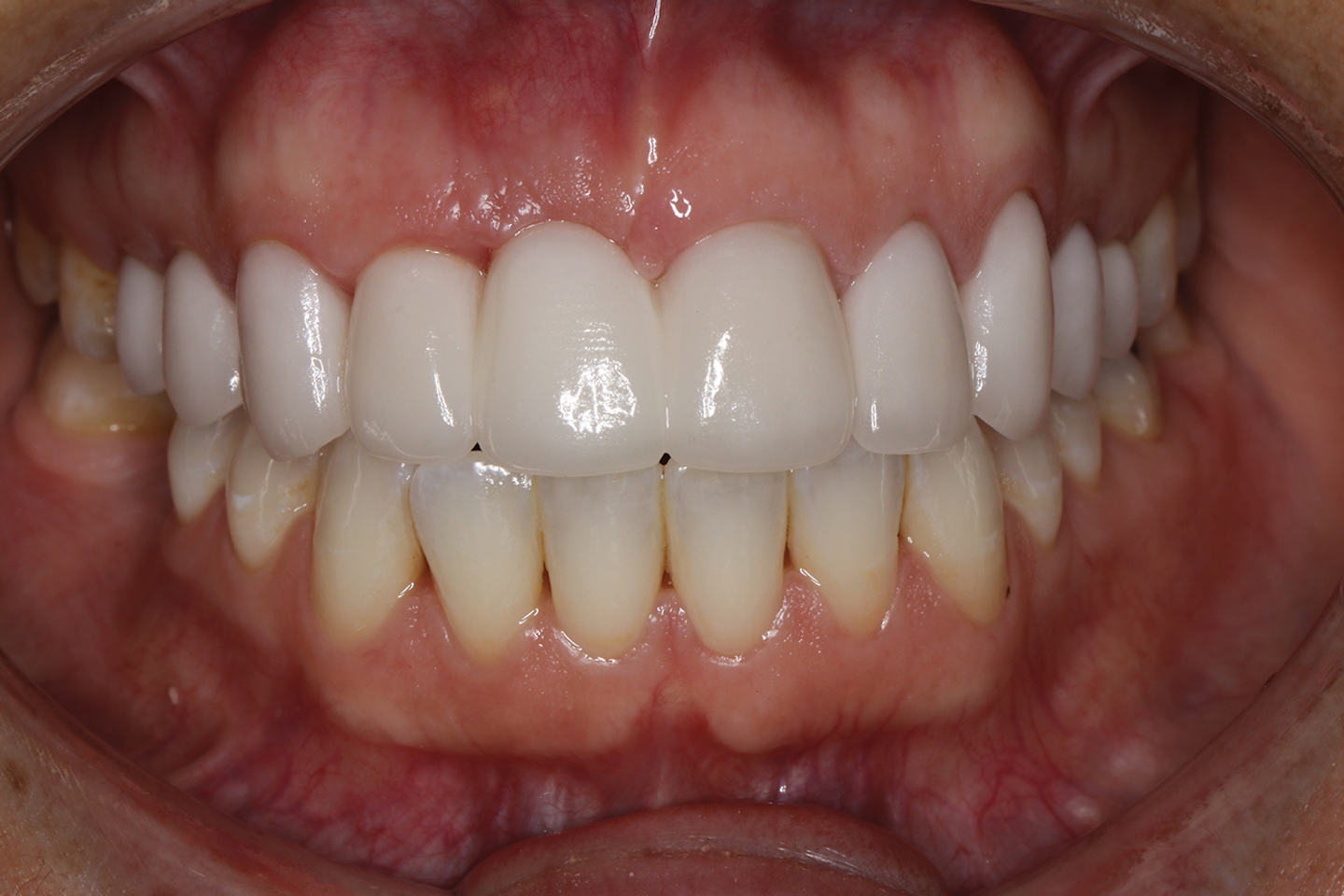 Bone grafting after tooth removal: Why, when, and what to use | Dental ...