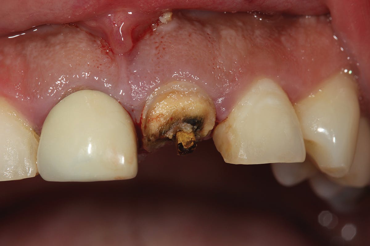 Bone grafting after tooth removal: Why, when, and what to use | Dental ...