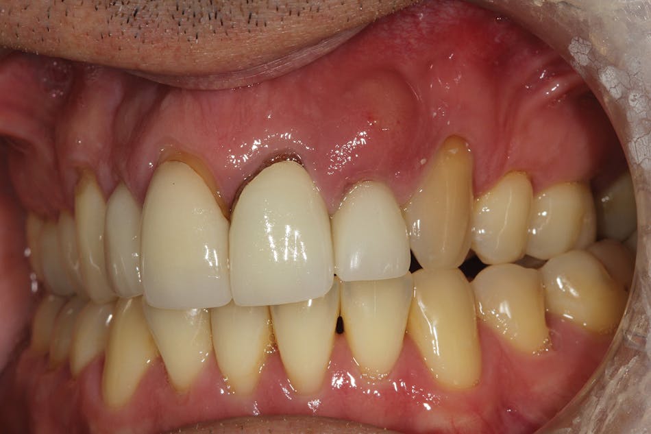 Bone grafting after tooth removal: Why, when, and what to use | Dental ...