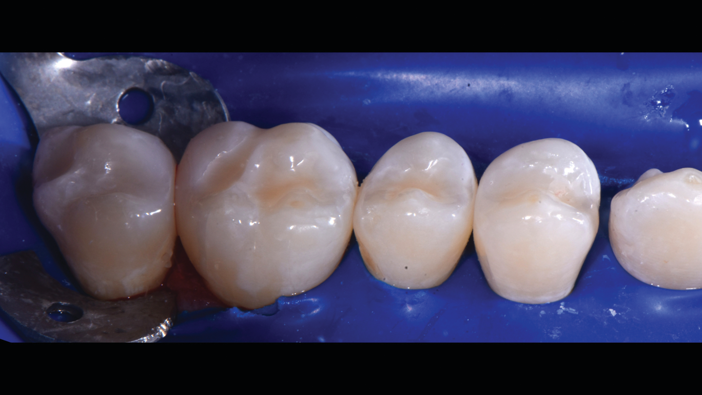 How to increase predictability and durability of posterior composite ...