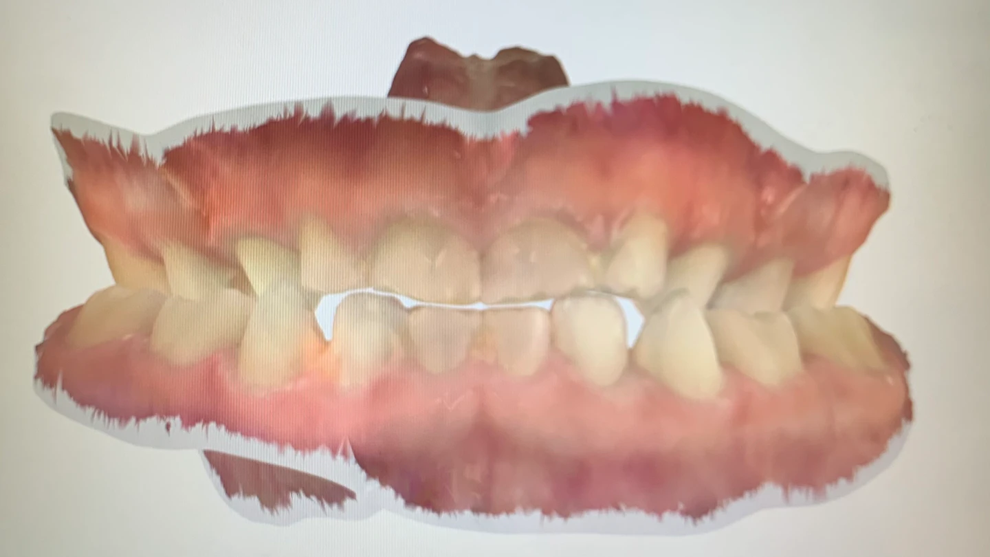 Intraoral scanners for the pediatric dental patient | Dental Economics