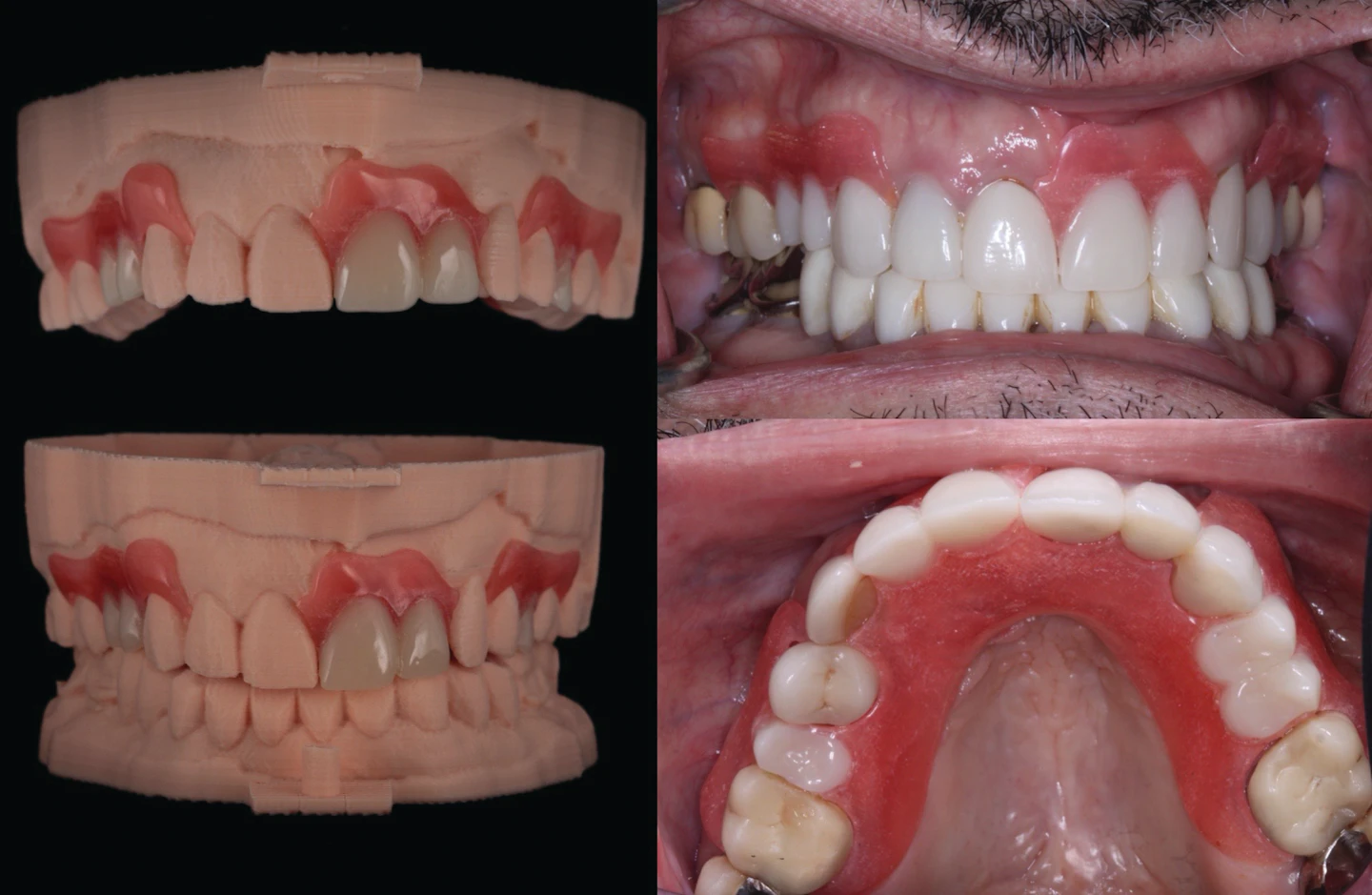 Dental 3D printers—a breakdown of different dental 3D printing ...