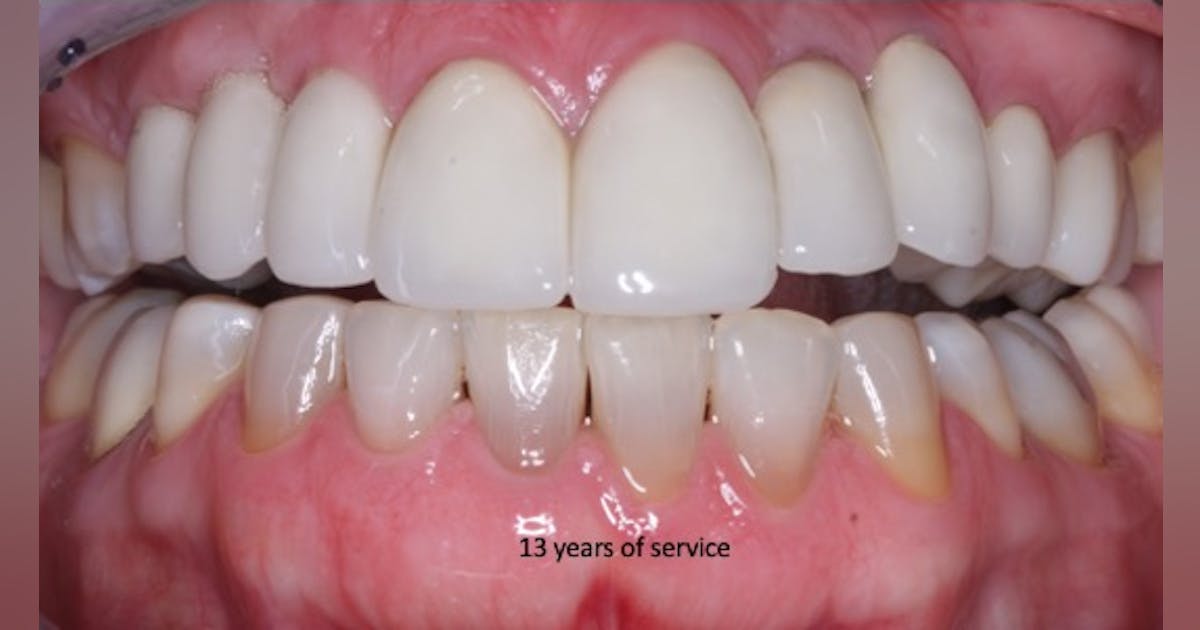 Is An Implant Better Than A Tooth Dental Economics is-an-implant-better-than-a-tooth-dental-economics