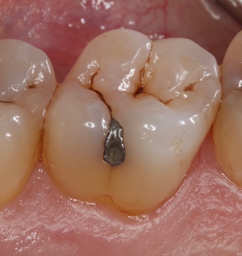 The clinical and practice benefits of a single-shade composite system ...