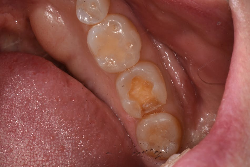 Best practices for class II restorations: Innovative thermoviscous bulk ...