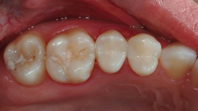 Are flowable composites adequate restorations? | Dental Economics