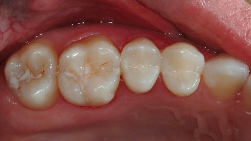 Are flowable composites adequate restorations? | Dental Economics