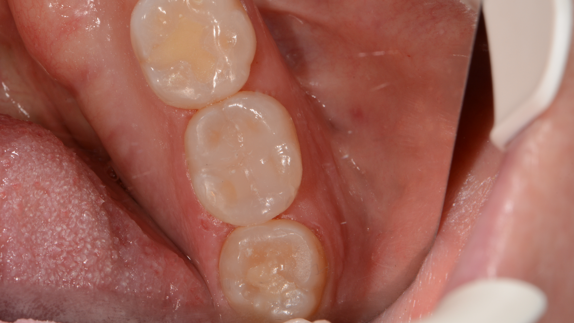 Best practices for class II restorations: Innovative thermoviscous bulk ...