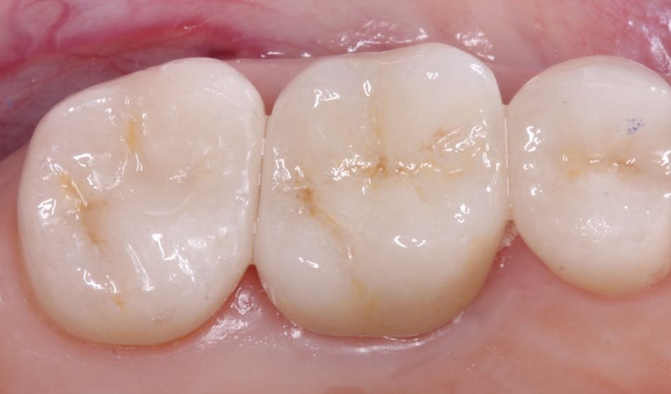 Are endodontic posts really necessary? | Dental Economics