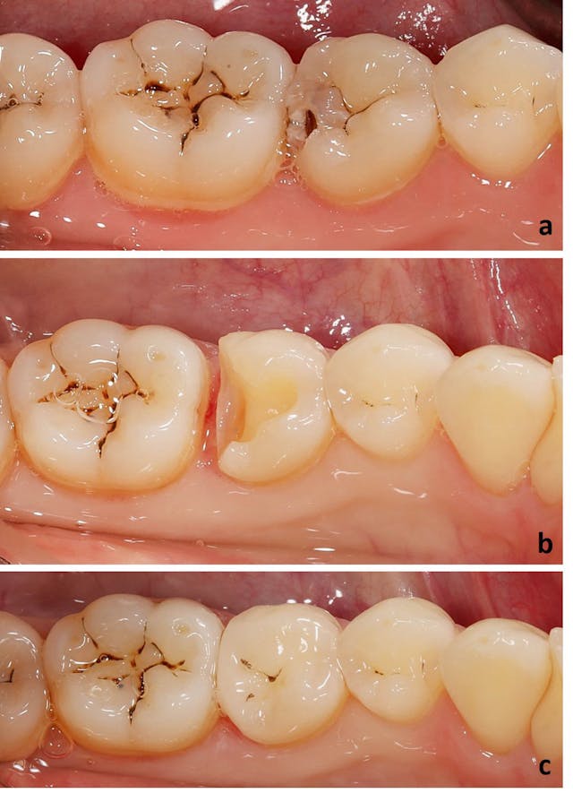 Choosing between complete (crown) or partial coverage (inlay and onlay ...