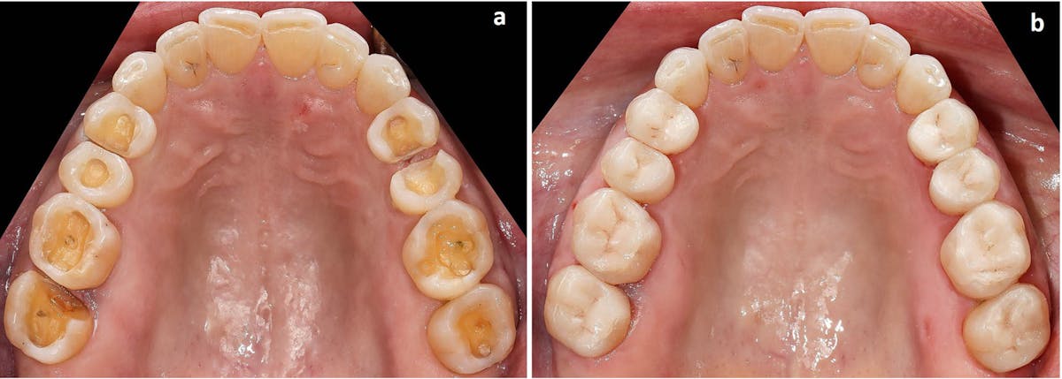 Choosing between complete (crown) or partial coverage (inlay and onlay ...