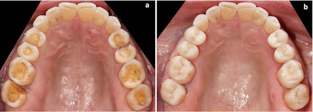 Choosing between complete (crown) or partial coverage (inlay and onlay ...