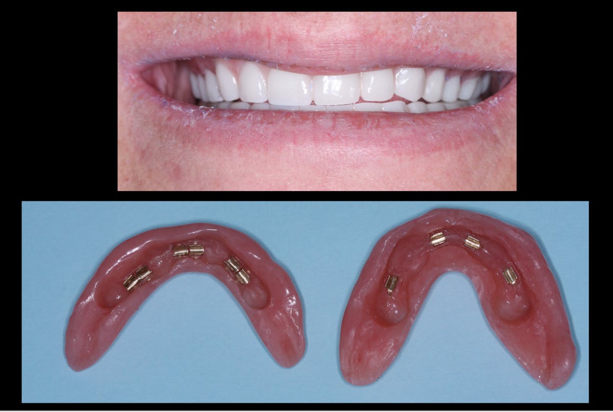 Occlusion in 2022: The forgotten area in dentistry | Dental Economics