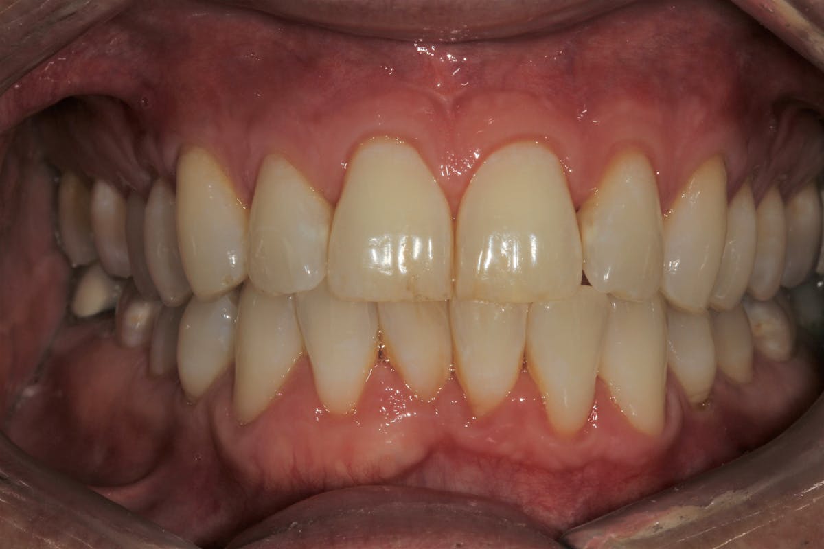 Pinhole Surgical Technique: A 10-year evaluation of root coverage ...