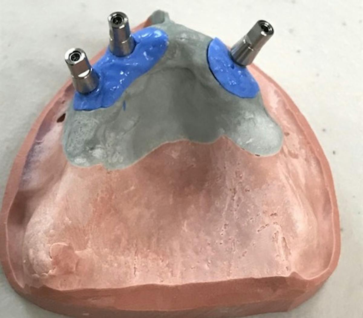 What are the main reasons for implant failure? | Dental Economics